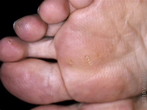 Young Plantar Warts
