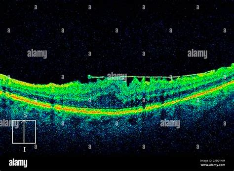 Epiretinal Membrane Optical Coherence Tomography Oct Scan Of A Section Through The Retina Of