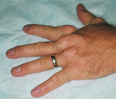 Xanthoma Eye Tendinous Tuberous And Disseminatum Causes And Treatment