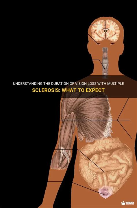 Understanding The Duration Of Vision Loss With Multiple Sclerosis What To Expect Medshun