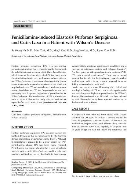 Penicillamine Induced Elastosis Perforans Serpiginosa And Cutis