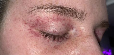 Why Do I Keep Getting Petechiae Rmedical