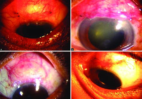 A Frill Incision Bleb At The End Of Surgery B Download Scientific Diagram