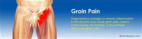 Groin Pain What Is Symptoms Causes Treatment In Men And Women