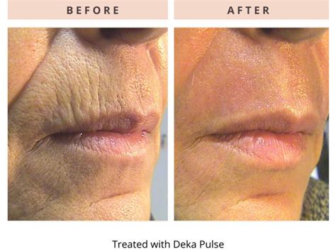 Helix Co2 Laser Northville Advanced Skin Resurfacing
