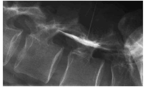 Epidural Contrast Injection Patient Is Lying In Prone