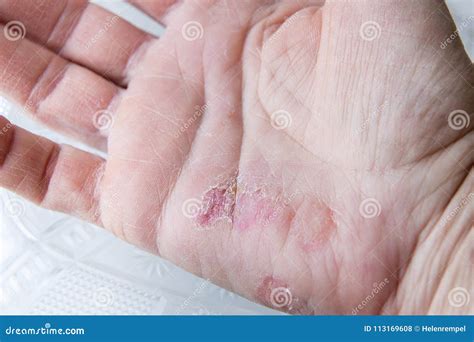 Piel Agrietada Y De La Peladura Seca Dolorida Extrema En La Mano Foto