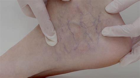 Minor Spider Veins