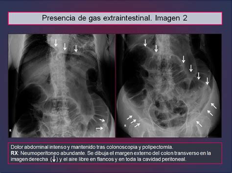 Figure 2 From Dolor Abdominal Agudo ¿qué Aporta La Radiografía Simple