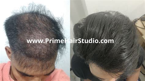Prime Hair Studio And Cosmetic Clinic Medicap Biofibre In Mumbai