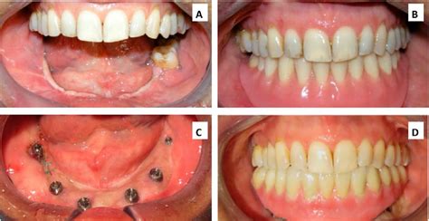 Figure 1 From Head And Neck Osteosarcoma—the Ongoing Challenge About