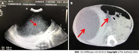 Hepatic Cyst Definition Liver Cysts Symptoms Puqrd