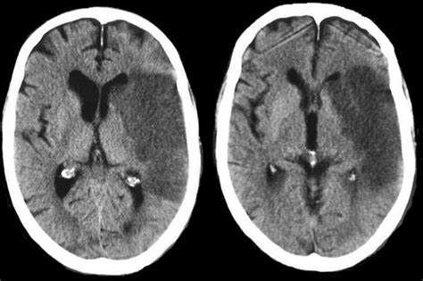 Dr Balaji Anvekar Frcr Ischemic Stroke And Vascular Territories Of Brain