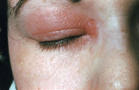 Types Of Eczema And Their Treatment Options — Houston Dermatology
