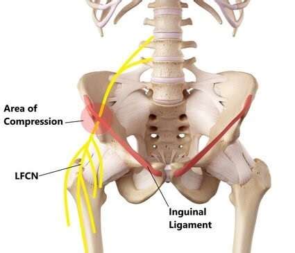 What Is Meralgia Paresthetica Causes And Treatment Backdoc