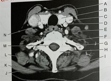 Transverse Ct Image Through The Neck At The Level Of The Trachea