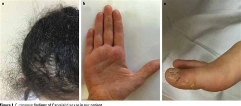 Figure 1 From A Novel Mutation In The Desmoplakin Gene In Two Female Siblings With A Rare Form