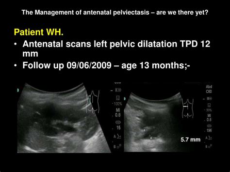 Ppt The Management Of Antenatal Pelviectasis Are We There Yet