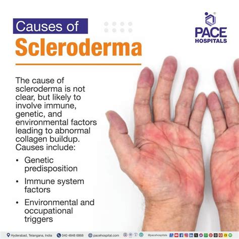 Scleroderma Symptoms Causes Diagnosis And Treatment