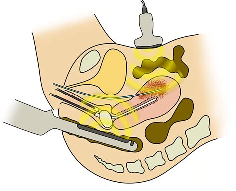 Internal Radiation Therapy Brachytherapy
