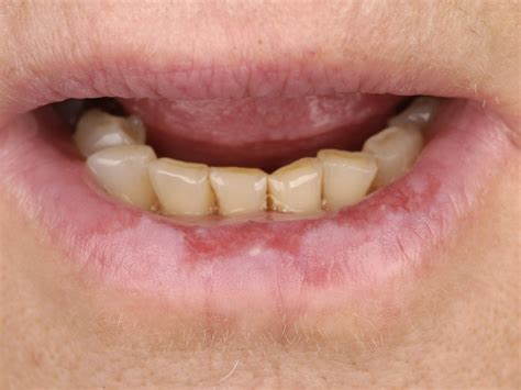 Exfoliatieve Cheilitis Genezing Help Me Alstublieft Extreem Droge