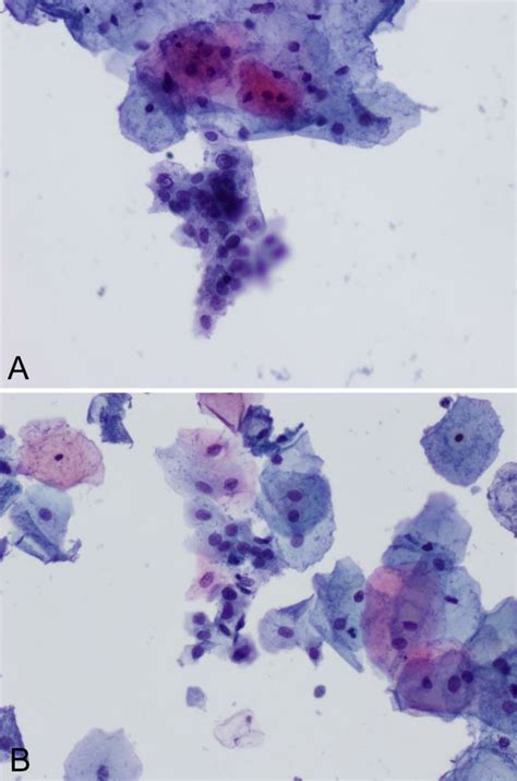 Liquid Based Cytology Thinprep Papanicolaou Stain 440x A And B Download Scientific Diagram