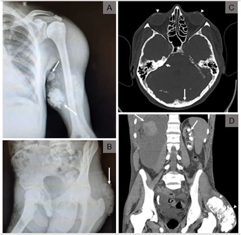Scielo Brazil Severe Hypercalcemia Caused By Repeated Mineral Oil Injections A Case Report
