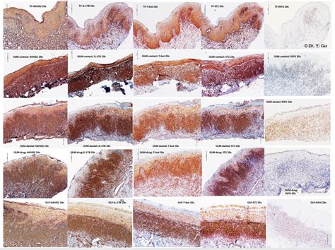 The Histopathological Difference Between Oral Lichen Planus And Oral