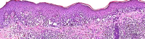 Histology Showing Superficial Spreading Component Of