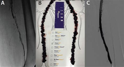 Peripheral Thrombectomy Simplified Integrating Aspiration And