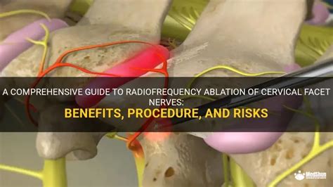 A Comprehensive Guide To Radiofrequency Ablation Of Cervical Facet Nerves Benefits Procedure