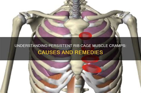 Understanding Persistent Rib Cage Muscle Cramps Causes And Remedies