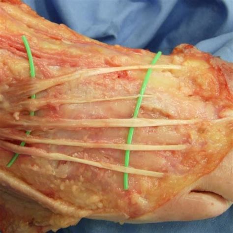 Case 2 Edl Extensor Digitorum Longus Edl Originates 3 Tendons T1 Download Scientific