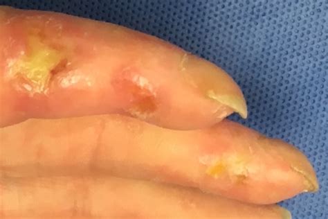 Scleroderma Systemic Sclerosis Crest Hand Surgery Resource
