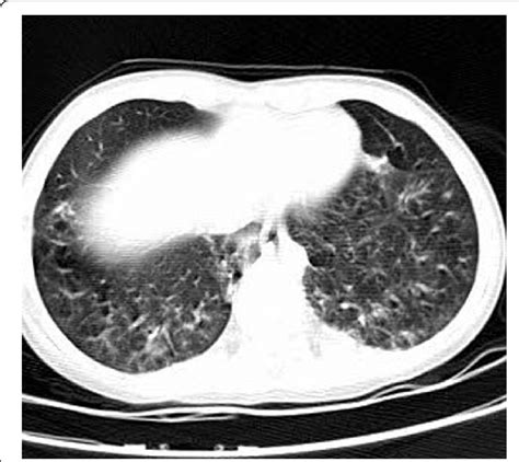 Interlobular Septal Thickening And Reticular Density In Both Lower