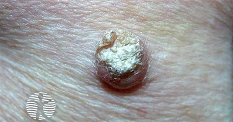 Dermnet® Keratoacanthoma Image