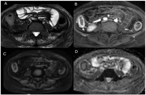 Imaging Of Ulcerative Colitis The Role Of Diffusion Weighted Magnetic