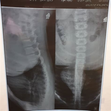 ابنتي عمرها ١٢ لديها خلع ورك ولادي اجريت لها عمليتان ولكن الطبي