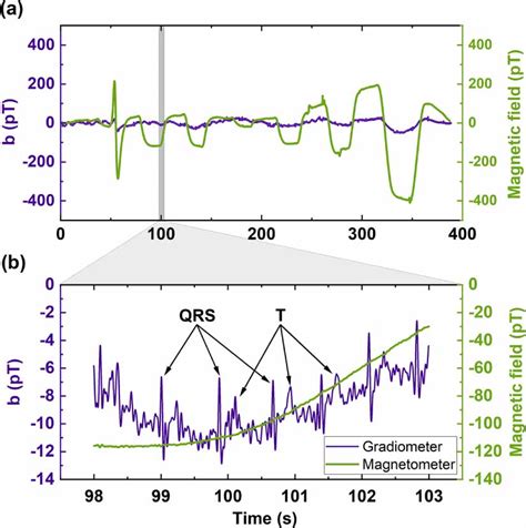 An Optically Pumped Magnetic Gradiometer For The Detection Of Human