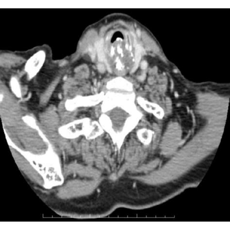 A Mass Is Seen In Subglottic Space Especially The Posterior Part With Download Scientific