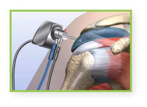 Shoulder Impingement Re Flex Super Specialty Clinic