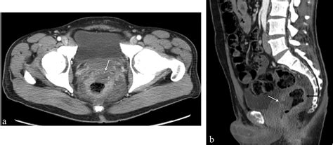 Imaging Features Of Anorectal Proctitis In Monkeypox Infection