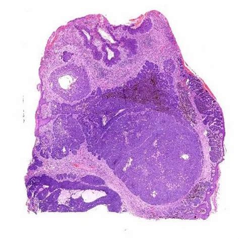 Oral Basal Cell Carcinoma