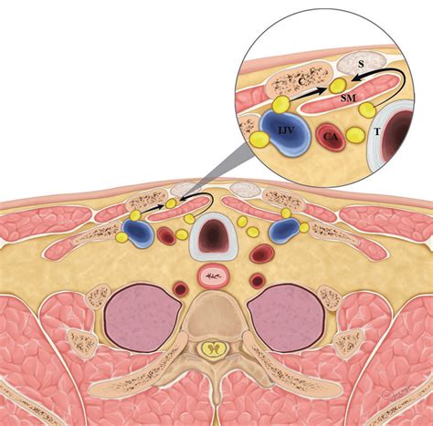 Schematic Illustration Of Two Pathways For Suprasternal Lymph Node
