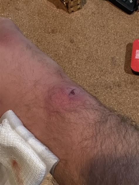 Drained Abscess Hand Swelling Rmedical