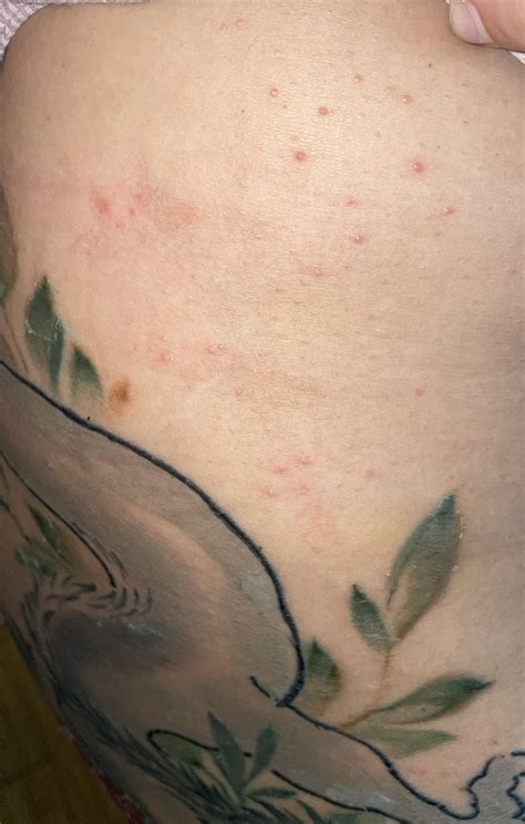 Red Dots Around Tattoo