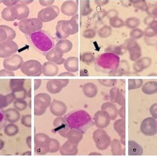 Peripheral Blood Film Shows Different Morphological Forms Of Reactive Download Scientific