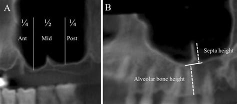 A Localization Of Maxillary Sinus Septa In Complete Posterior