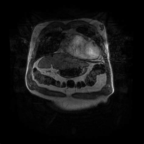 Aortic Dissection Stanford A Debakey I Radiopaedia 23469 23551 D