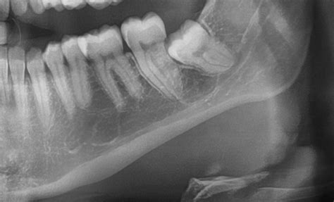 Hi I Will Get This Impacted Wisdom Tooth Removed In A Couple Of Weeks